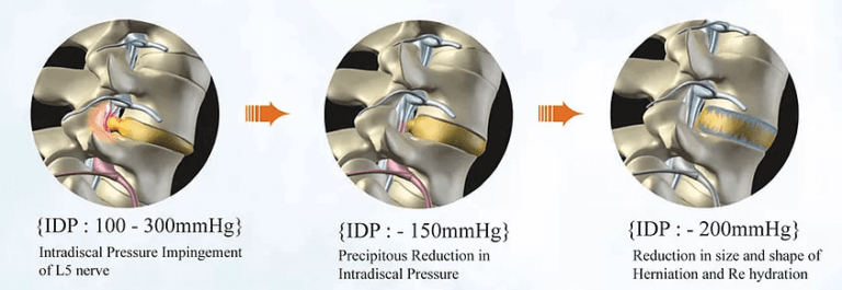 Extentrac Elite Key Technology Advantages
